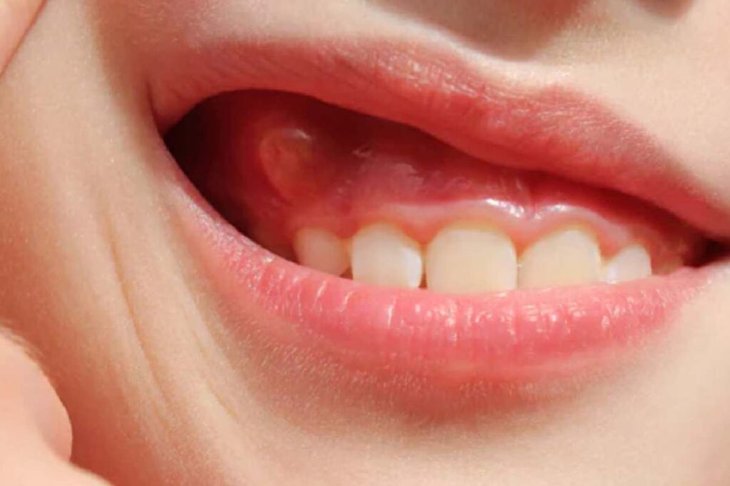 Pictures of Gum Boils-A Brief Description