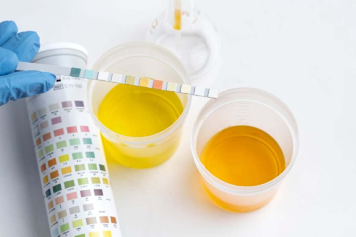 Pus Cells in Urine 25-30 Hpf Treatment - Describe, Briefly